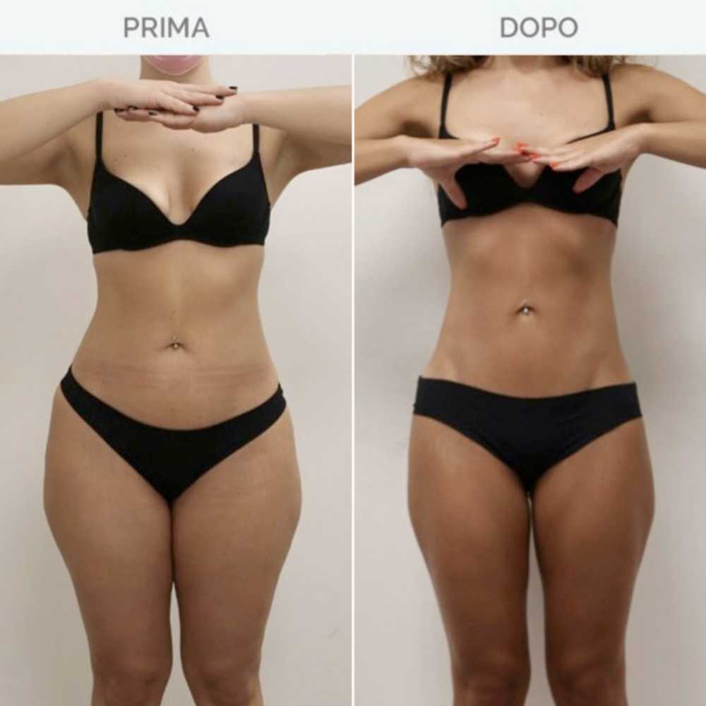 Criolipolisi: il segreto per silhouette snella e tonica | Olivia Cooper